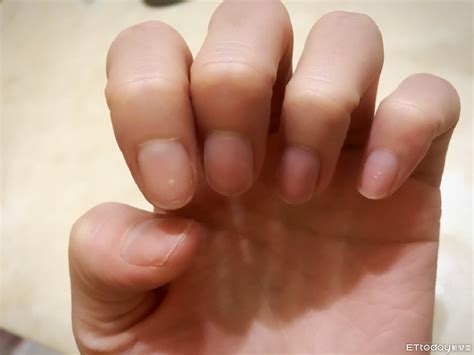 從指甲看「5個身體警訊」 營養師：變薄凹陷可能是貧血 Ettoday健康雲 Ettoday新聞雲