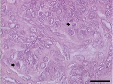 Neoplastic Basaloid Cells With Oval Hyperchromatic Nuclei And Scant