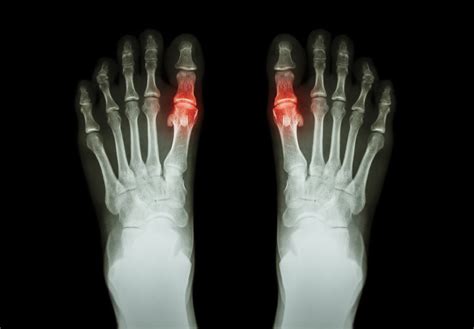 Great Mcp Joint Of Toe