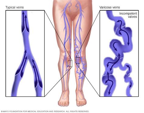 Varicose Veins Symptoms And Causes Mayo Clinic