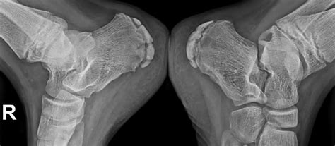 Sever S Disease Calcaneal Apophysitis Assoc Dr Murat Kaya