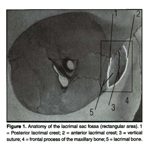 Posterior Lacrimal Crest
