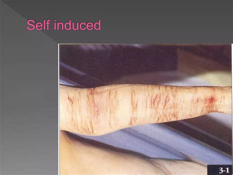 Incised Wounds By Drm Balaji Singh Acsmch Chennai 2020 Pptx