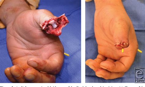 Traumatic Amputation