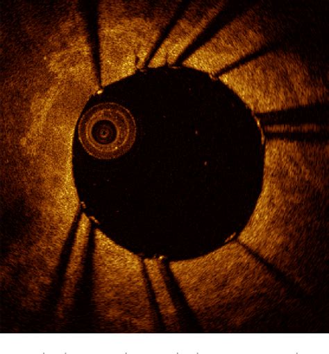 Figure 9 From Automatic Three Dimensional Registration Of Intravascular Optical Coherence