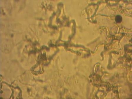 The Mods Method For Diagnosis Of Tuberculosis And Multidrug Resistant Tuberculosis