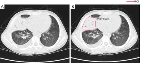A Sample Of Manually Segmenting And Contouring Rois A An Original