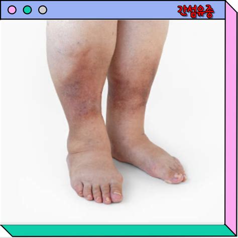 간 섬유증 초기 증상과 징후 그리고 간 섬유화 검사 수준 및 좋은 음식 정보 네이버 블로그