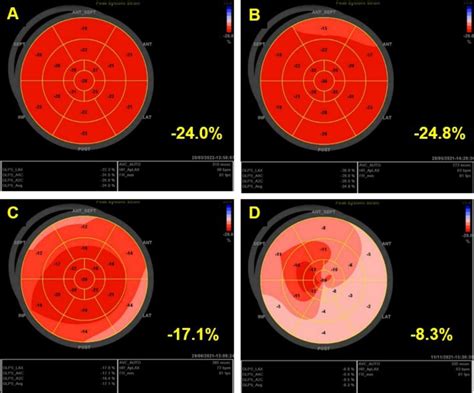 Representative Examples Of Global Longitudinal Strain GLS Bulls Eye