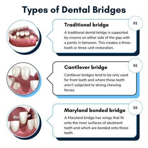 What Is A Dental Bridge Comprehensive Guide Savannah Dental