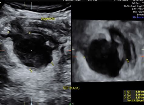 Appendicular Mass Looking Through A Transducer