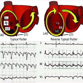 Variable Atrioventricular Conduction In A Typical Atrial Flutter The Download Scientific