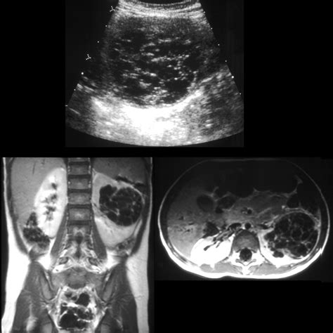 Pediatric Cystic Nephroma Pediatric Radiology Reference Article