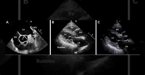 Left Atrial Appendage Closure Simplified Procedure And Unforeseen Challenges Medsynapse