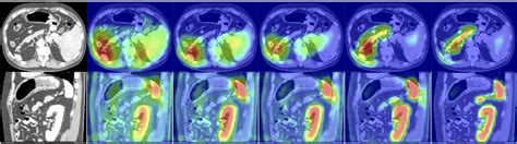 Review Attention U Net — Learning Where To Look For The Pancreas Biomedical Image Segmentation