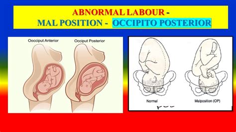 Abnormal Labour Mal Position Occipito Posterior Obg Youtube