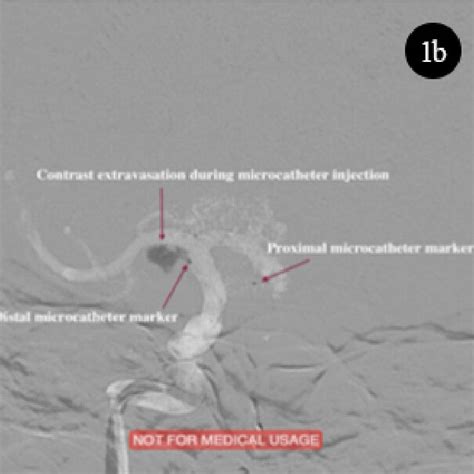 A Digital Subtraction Angiography Of The Right Internal Carotid Artery