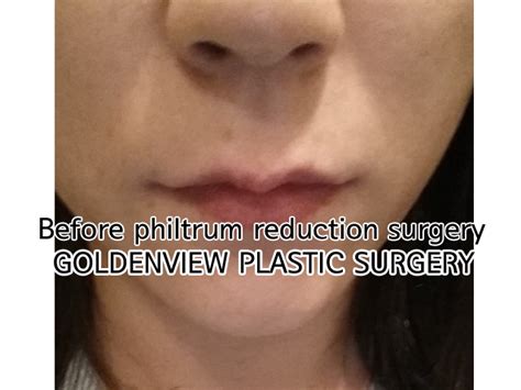 Goldenview Plastic Surgery Lip Lift Lip Plastic Surgery Phiptrum