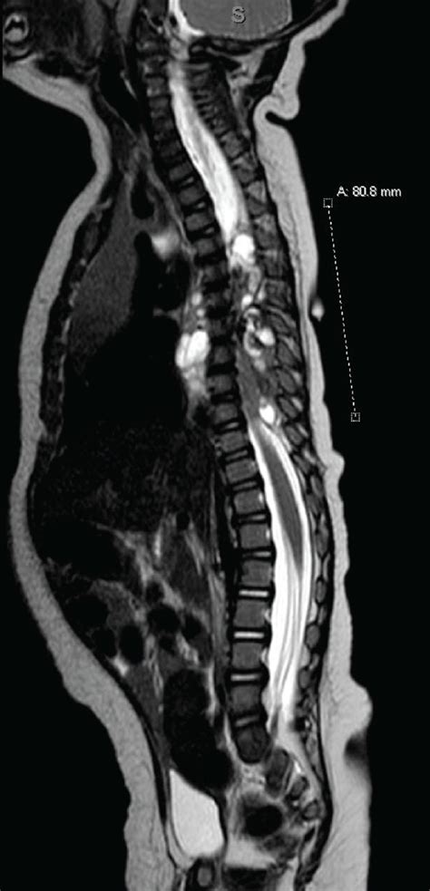 A Sagittal T2 Weighted Mr Image Showing Multilobulated Partially