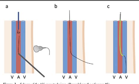 Figure 3 From Role Of Percutaneous Deep Venous Arterialization For