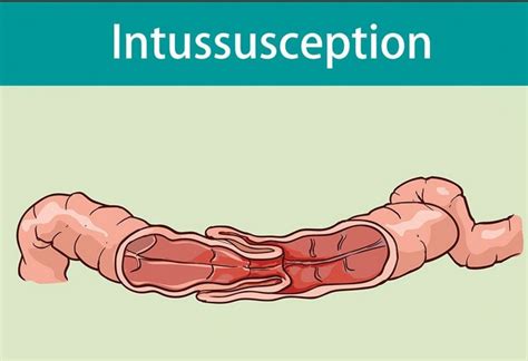 Mengenal Intussuseption Dan Penyebabnya