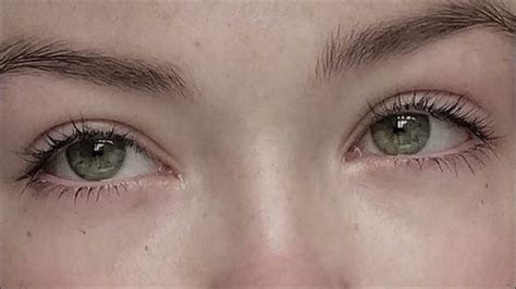 Tighten Lower Eyelids Remove Scleral Show 𝐩𝐚𝐢𝐝 𝐫𝐞𝐪𝐮𝐞𝐬𝐭 Youtube