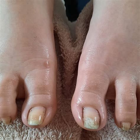 White Spots On Toenails After Removing Nail Polish