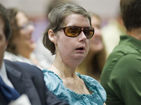 Military Hopes To Learn From Chimp Attack Victims Face Transplant