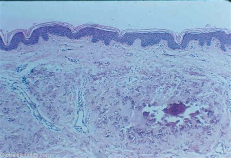 Global Skin Atlas Diagnosis Detail
