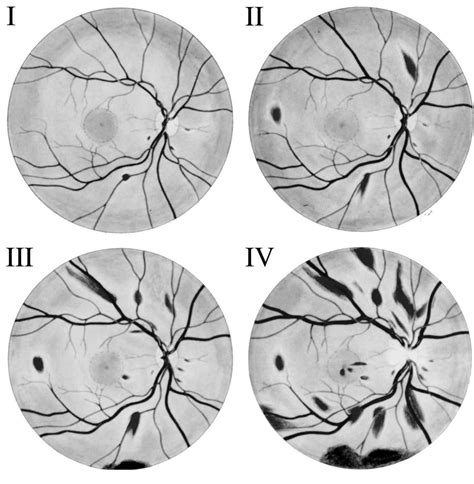 Classification Of High Altitude Retinal Hemorrhages