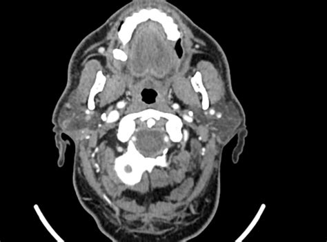 Calcular Parotitis Radiopaedia 54178 60361 C Nc Commons