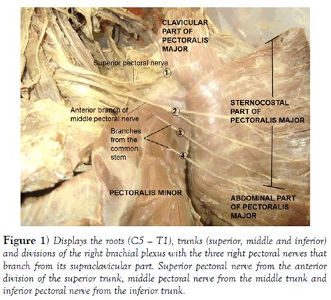 Supraclavicular Nerve Cadaver Supraclavicular Nerve Cadaver