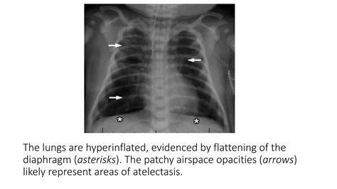 Neonatal Chest X Ray Pptx