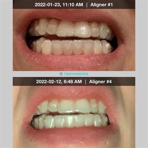Start Of Treatment 420 No Noticeable Progress So Far Invisalign