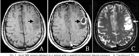 Ct Scan For Meningitis Comprehensive Guide To Diagnosis And Imaging