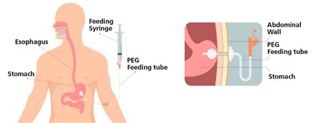 What Is The Difference Between A Peg And A Rig Feeding