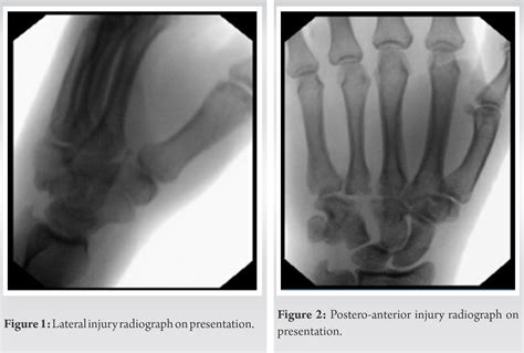 Isolated Hamate Dislocation A Case Report And Technique Guide Journal Of Orthopaedic Case Reports