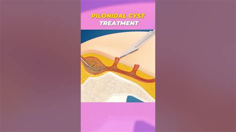 Pilonidal Cyst Treatment Explained 3d Medical Animation In 60 Seconds