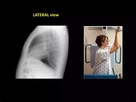 Chest X Ray Interpretation PDF