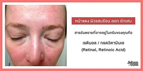 สังเกตให้ดี คุณกำลังมีอาการผิวติดสารอันตรายอยู่หรือเปล่า