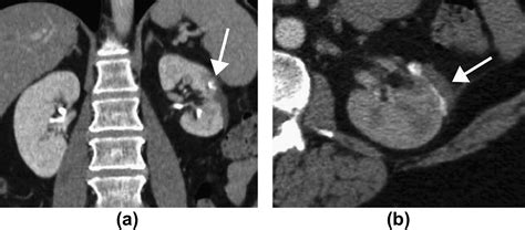 Making Sense Of Postoperative Ct Imaging Following Laparoscopic Partial Nephrectomy Clinical