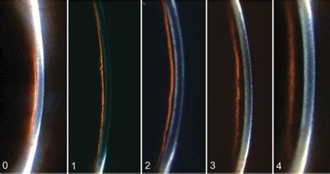 Anterior Chamber Cells Slit Lamp