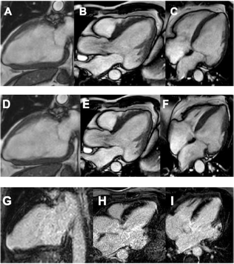 Apical And Basal Inferolateral Aneurysm With The Corresponding Scar At