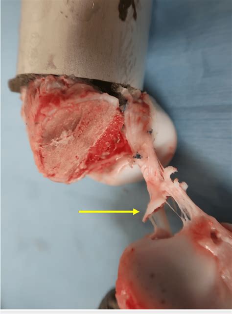 Avulsion At The Tibial Side Of The Anterior Cruciate Ligament