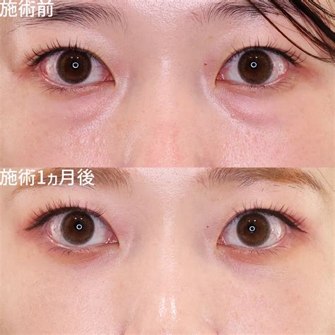【クマ取り】メイクで隠せない立体的なクマを改善【脂肪注入】｜症例写真・ビフォーアフター｜美容整形･美容外科のtaクリニックグループ