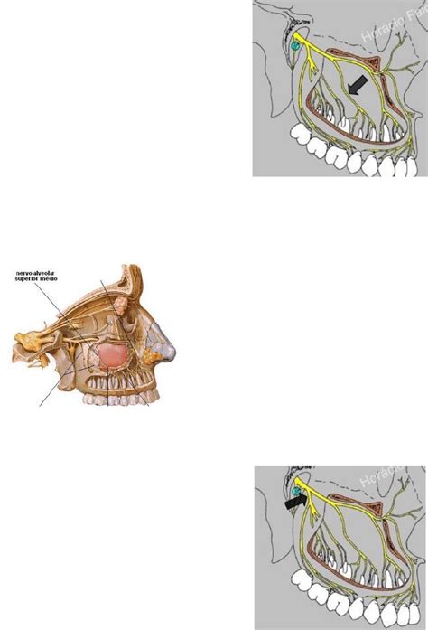 The Posterior Superior Alveolar Nerve And How To Properly Anesthetize