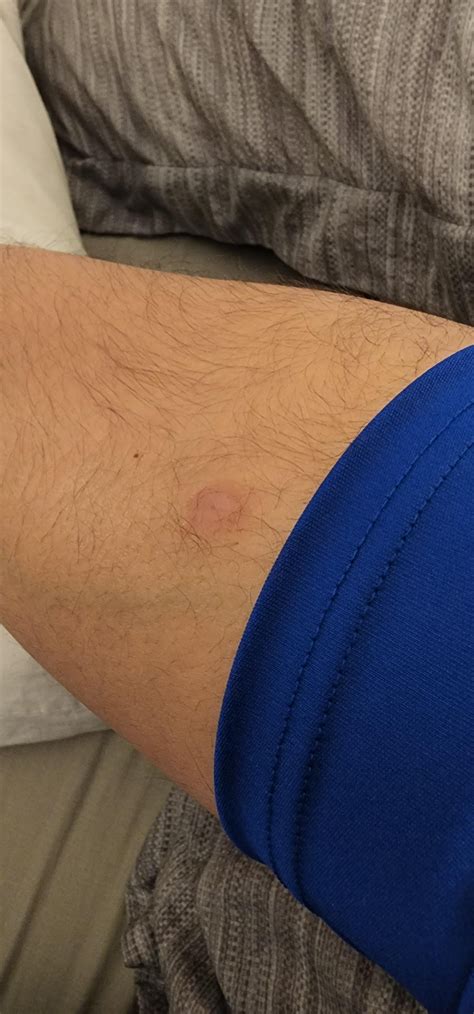 Does This Look Like Mrsa Rmrsa