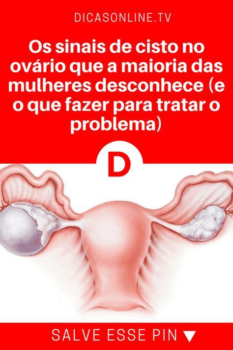 Cisto no ovario Os sinais de cisto no ovário que a maioria das