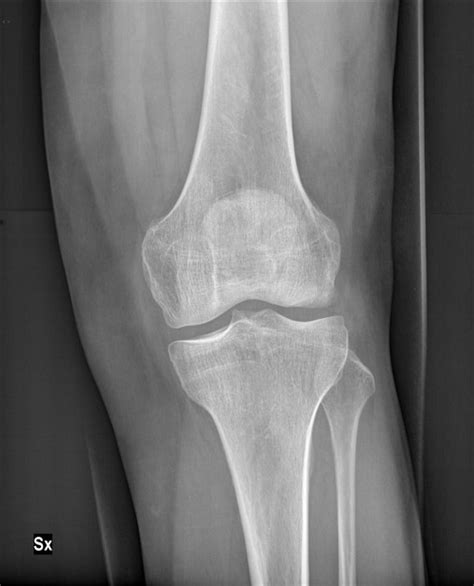 Knee Dislocation