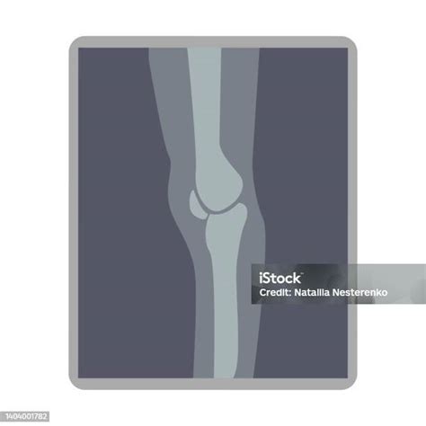 Knee X Ray Image Semi Flat Color Vector Object向量圖形及更多膝頸圖片 膝頸 圖示 卡通